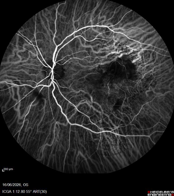 What is Indocyanine Green Angiography (ICG)? - Royal Victoria Eye and ...
